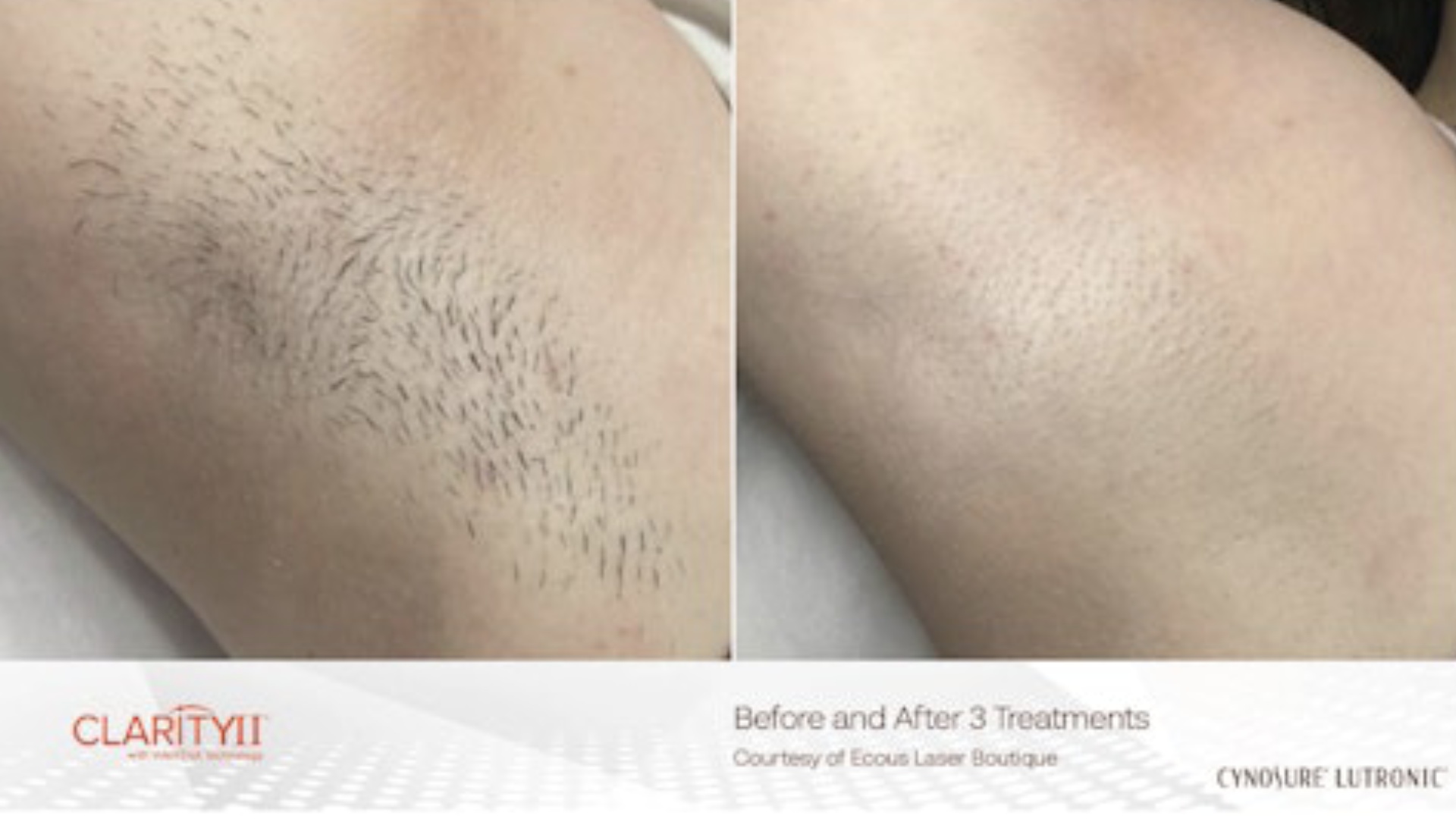Clarity II™ Laser Services | Lake Norman Weight Loss & Wellness